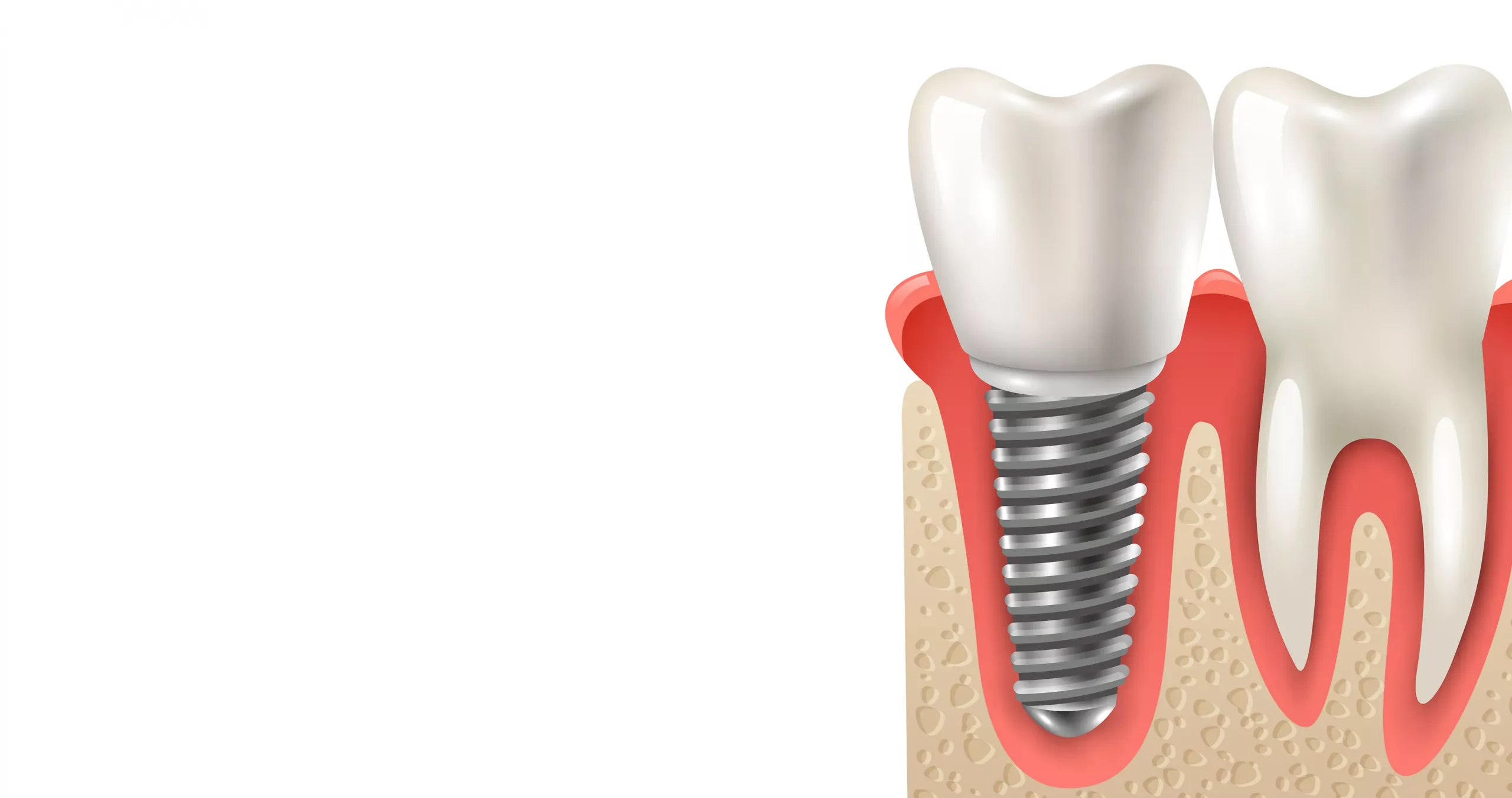 Implantologie - DHUC Zahnärzte in Hannover